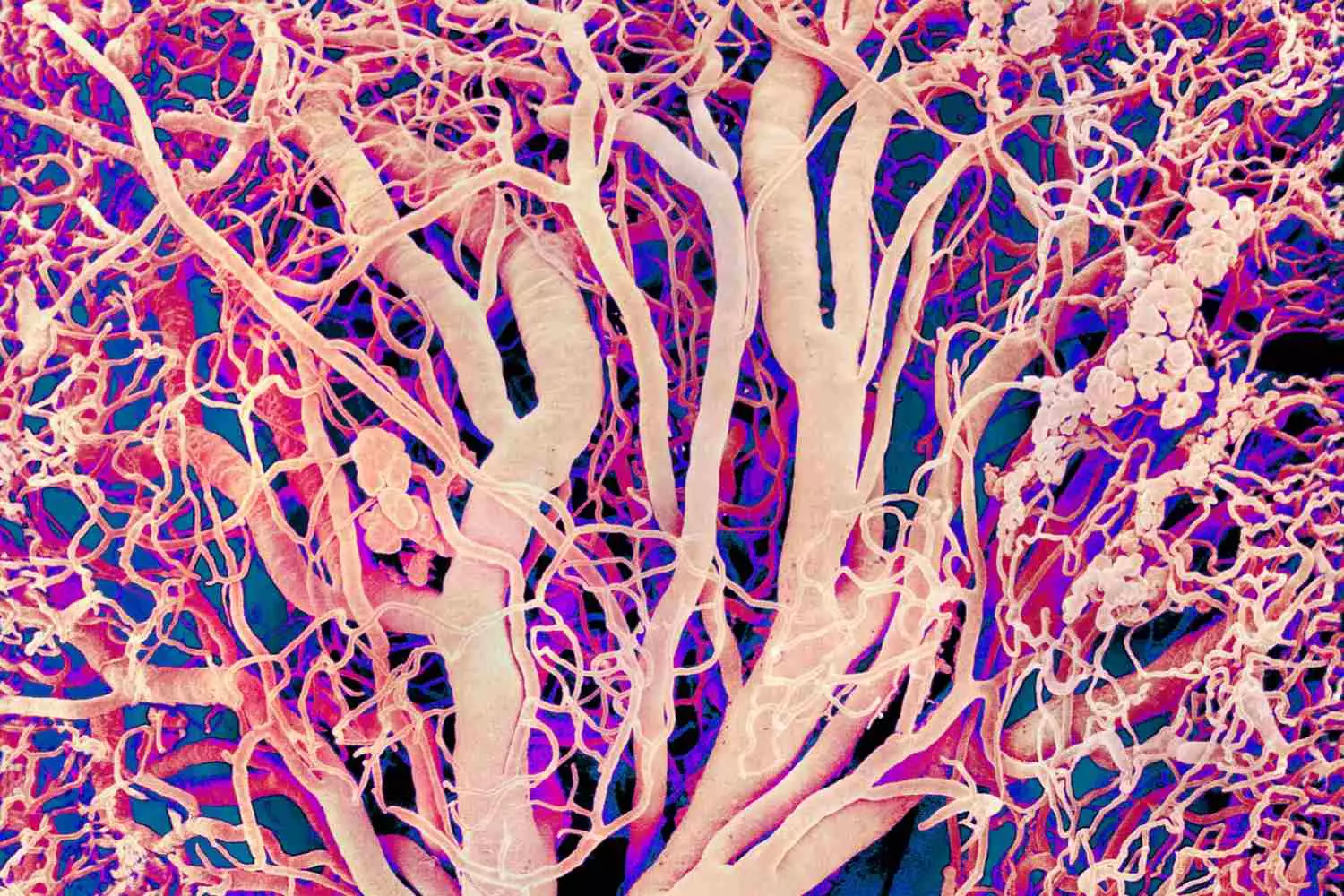 Krāsains skenējošs elektronu mikrogrāfs (SEM) ar sveķiem izlietiem asinsvadiem cilvēka audos
