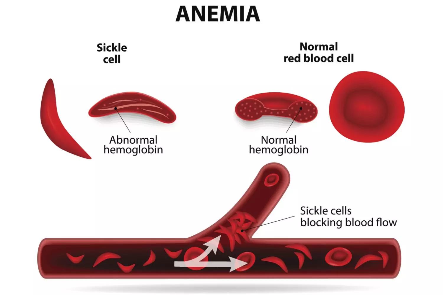 ພະຍາດເລືອດຈາງ Sickle Cell