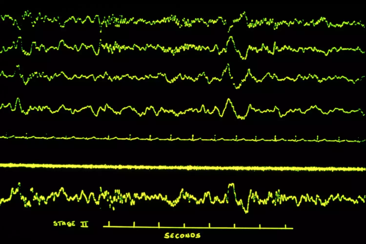 Stage 2 Non-REM Sleep