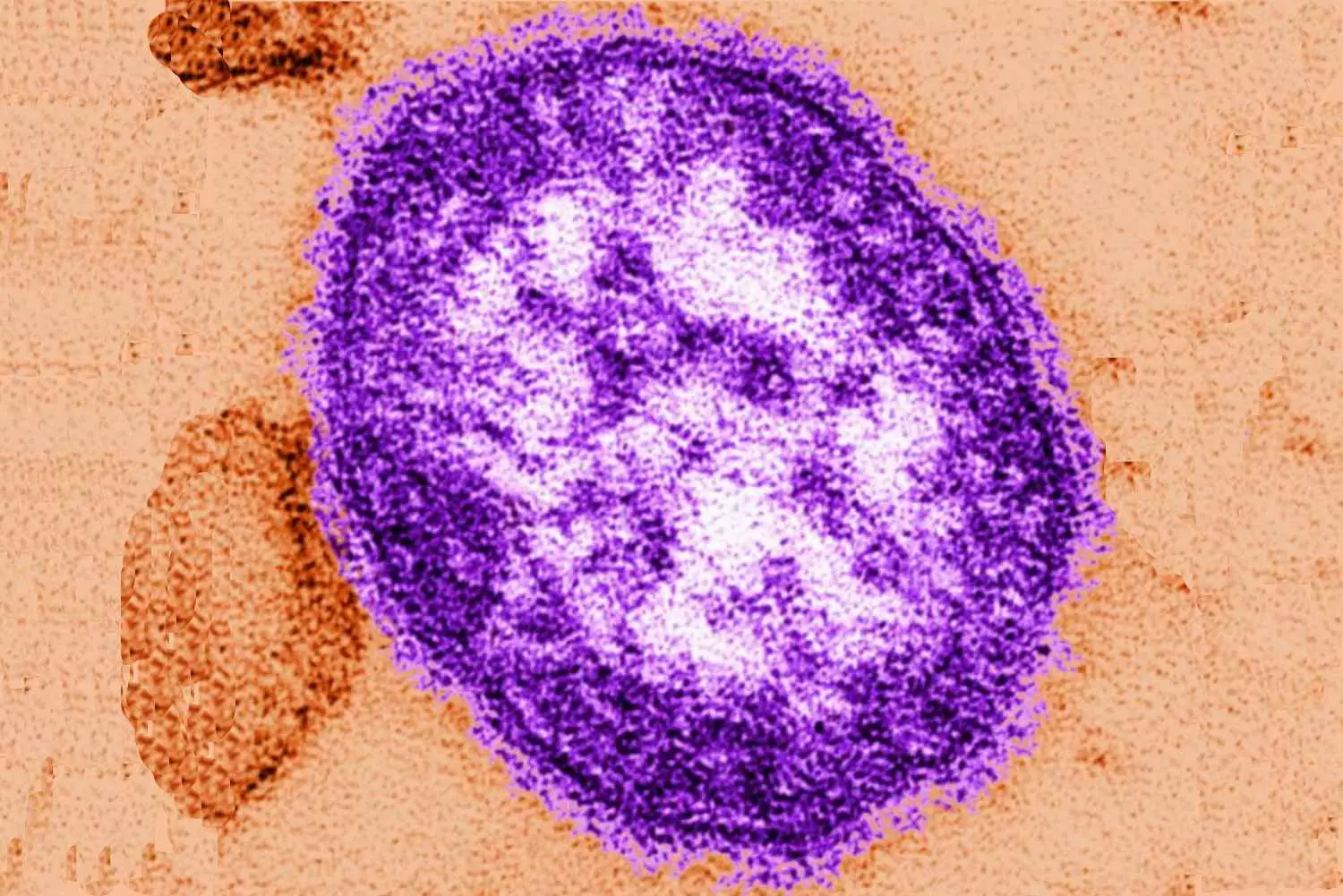 Masern Virus